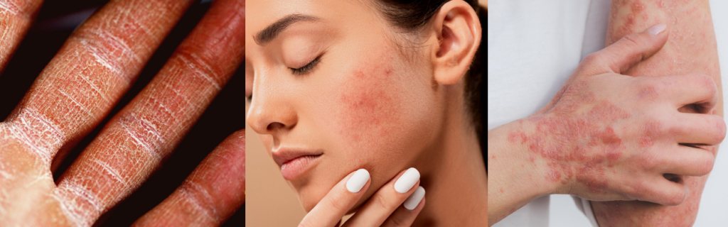 Affections cutanées - HYDROGEN affections cutanées